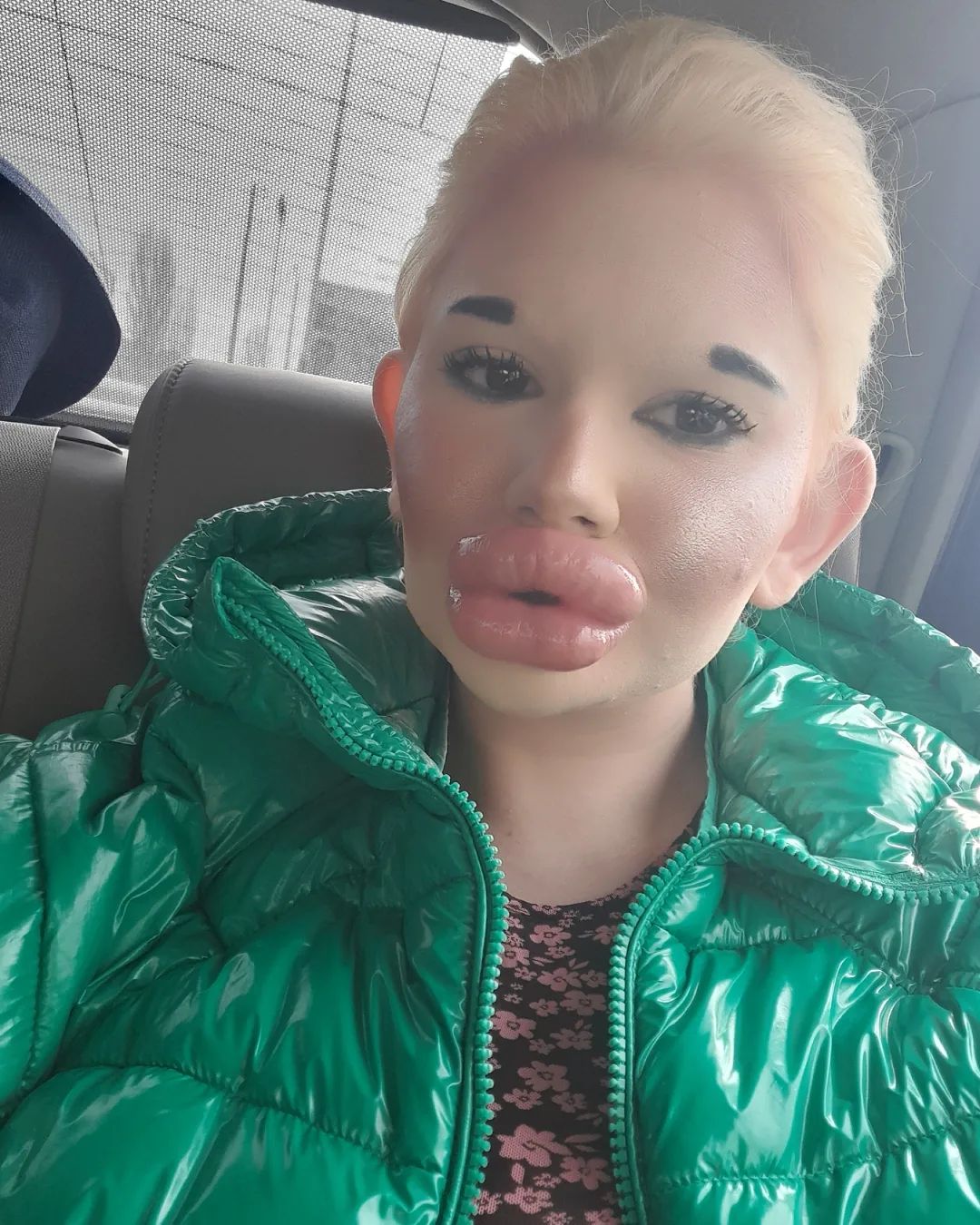 La Fille Aux Plus Grandes Lèvres Du Monde Sest Fait Agrandir Pour La