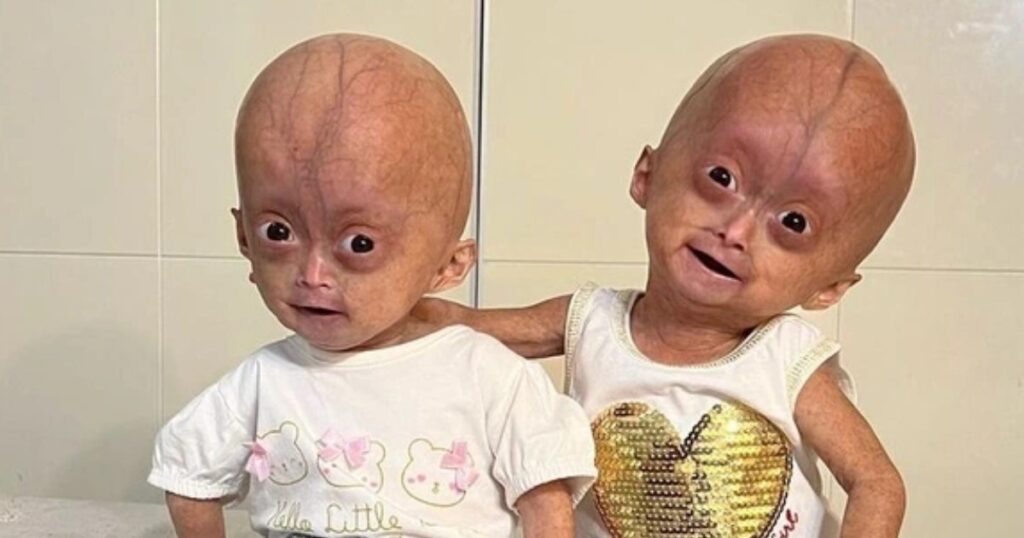 « Jumelles nées avec le syndrome rare de Benjamin Button » : à quoi ...